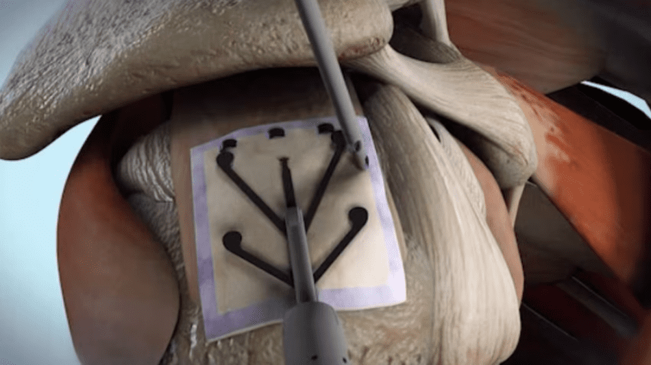 Smith+Nephew's absorbable rotator cuff implant sees 86% fewer new tears ...