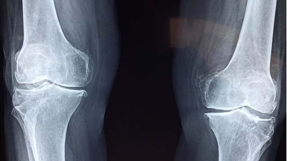 Moximed struts to FDA approval for knee shock absorber implant ...