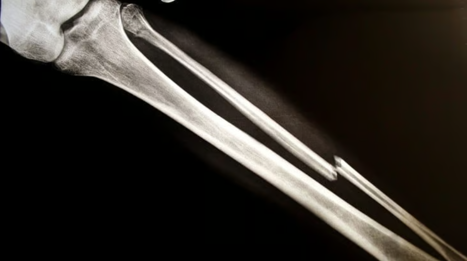 University of Utah's Bone Bolt system for complex fractures earns FDA ...
