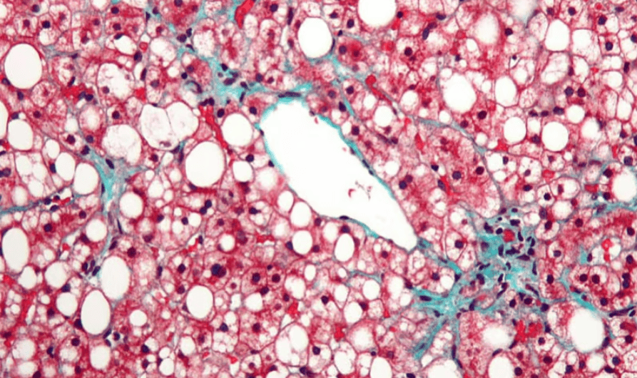 Sagimet's NASH drug-GLP-1 combo outperforms either alone for fibrosis ...