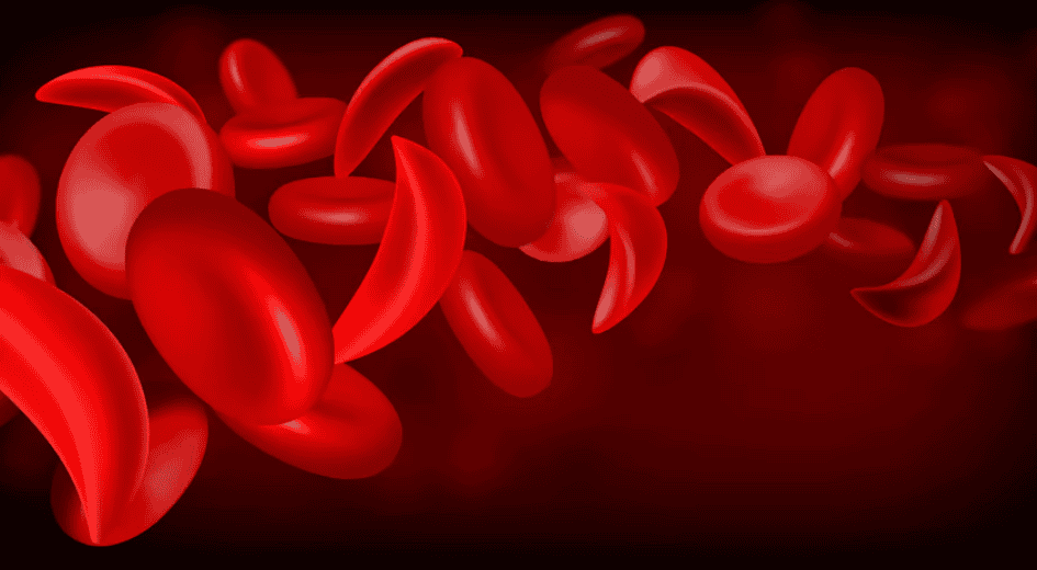 After terminating one of 2 late-stage sickle cell disease trials ...