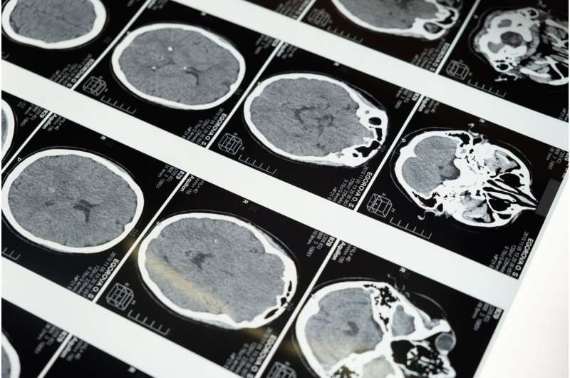 AI diagnoses brain tumors in minutes instead of weeks - Biotech Today